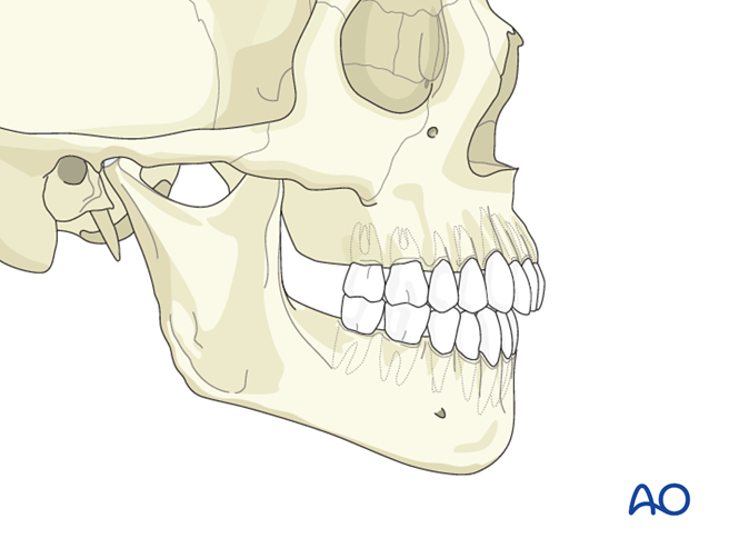Mandibular alveolar retrusion