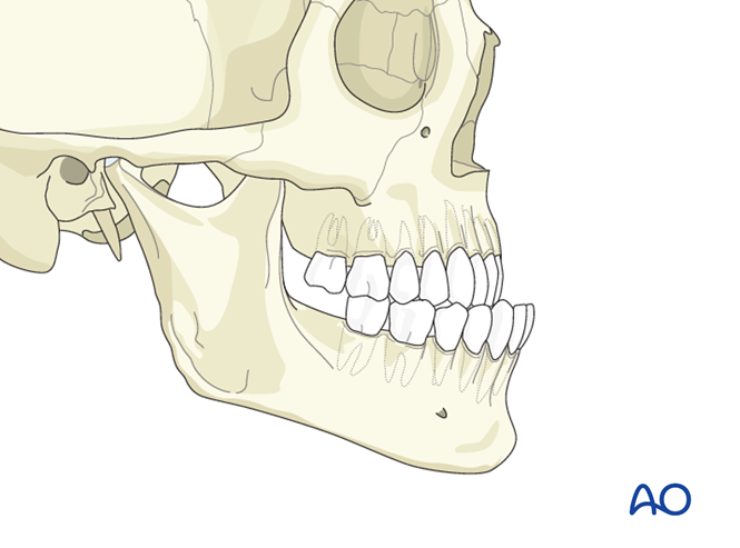 Maxillary retrognathism