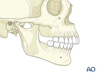 Maxillary prognathism
