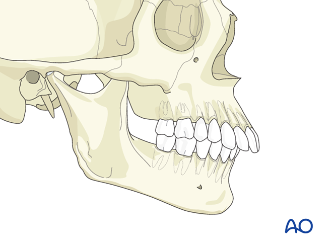 Maxillary alveolar protrusion