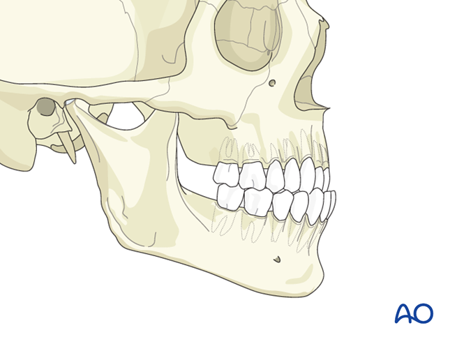 Maxillary alveolar retrusion