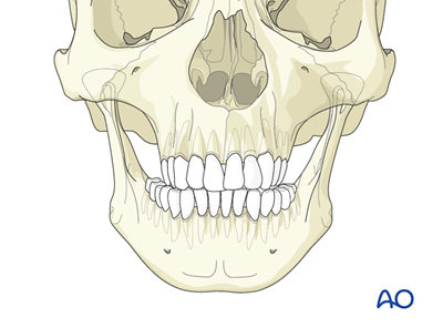 Transverse hypoplasia of maxilla