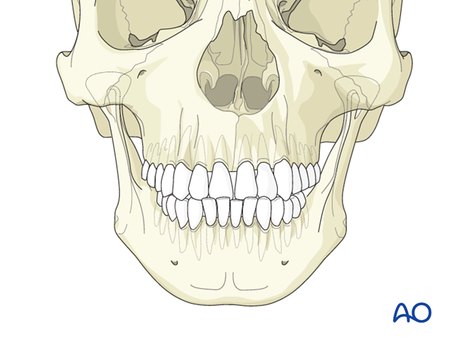 Transverse hyperplasia of maxilla