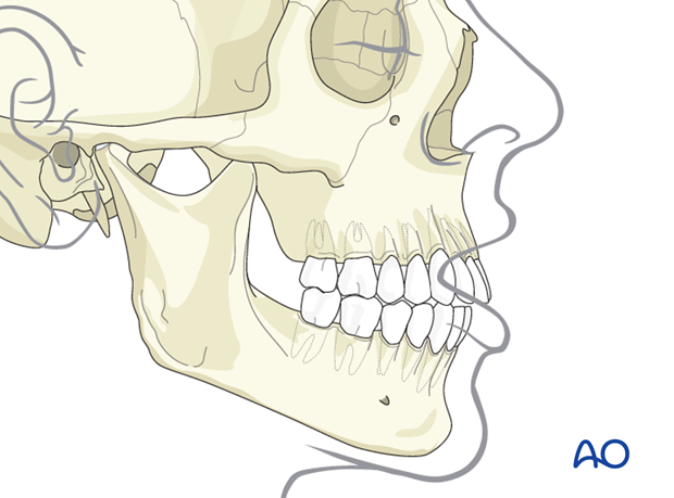 Vertical maxillary hyperplasia