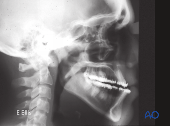 Mandibular prognathism
