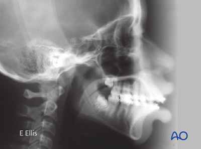 Mandibular alveolar protrusion