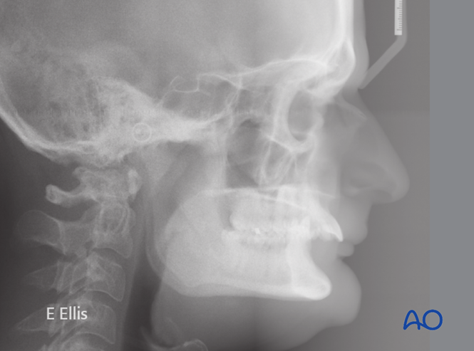 Mandibular retrognathism