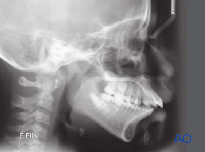 Maxillary alveolar protrusion