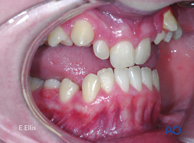 Maxillary alveolar retrusion