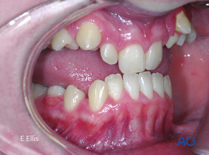 Maxillary alveolar retrusion