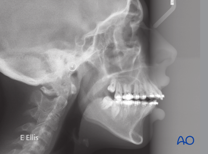 Vertical maxillary hyperplasia