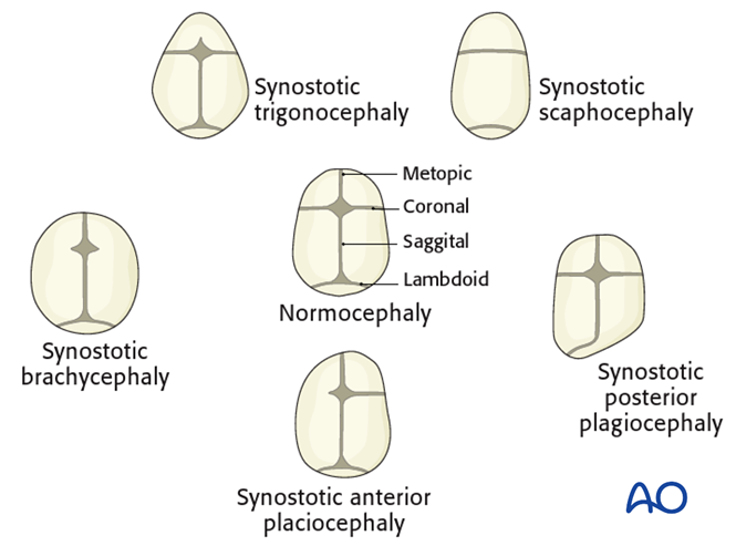 Introduction to craniosynostosis