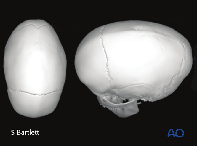 Early surgical treatment for Sagittal synostosis