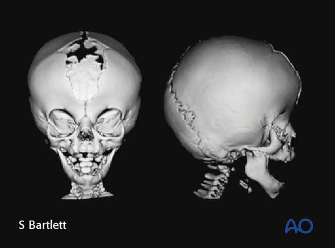 Syndromic craniosynostosis