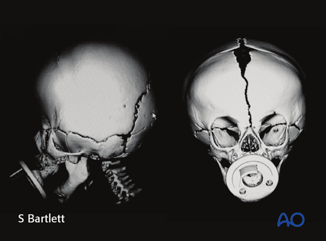 Syndromic craniosynostosis