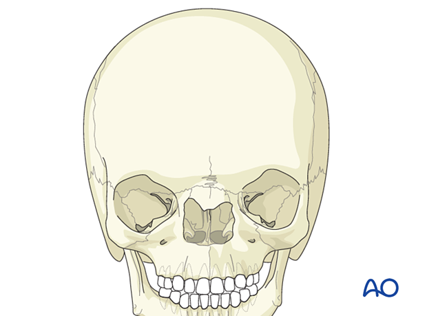 Intraorbital hypertelorism