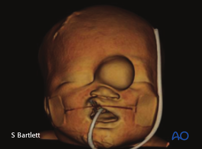 Interorbital hypertelorism