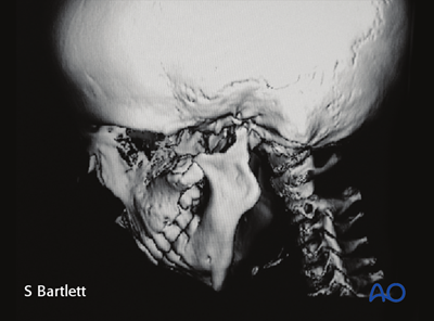 Treacher Collins Syndrome