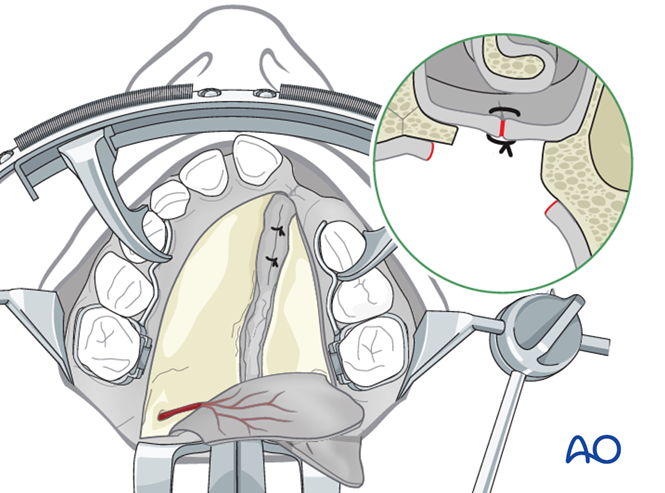 Alveolar bone grafting for Unilateral cleft lip and/or palate