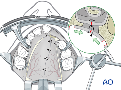 Alveolar bone grafting for Unilateral cleft lip and/or palate