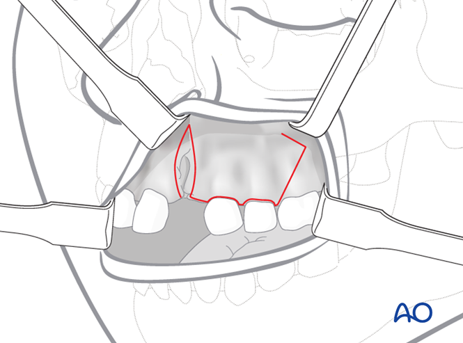 Alveolar bone grafting for Unilateral cleft lip and/or palate