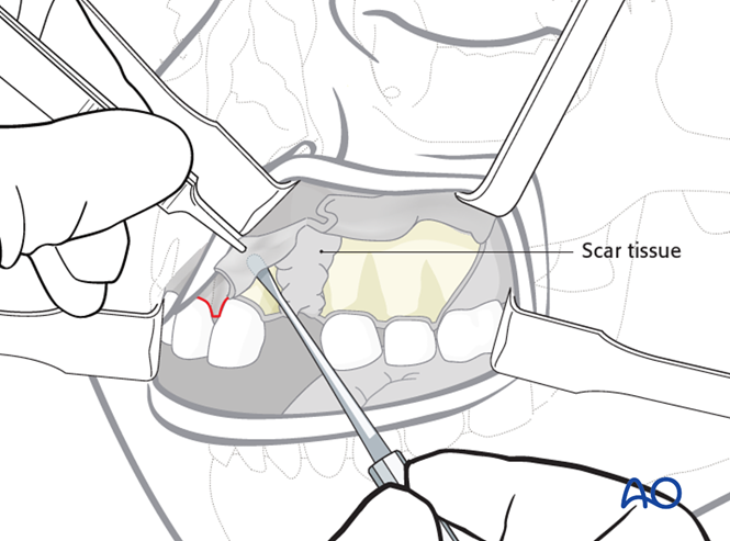 Alveolar bone grafting for Unilateral cleft lip and/or palate