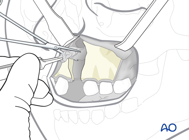 Alveolar bone grafting for Unilateral cleft lip and/or palate