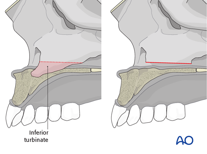 Alveolar bone grafting for Bilateral cleft lip and/or palate with ...
