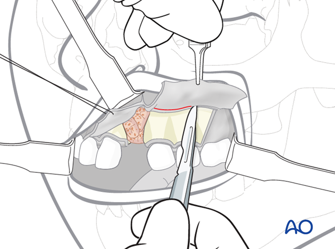 Alveolar bone grafting for Unilateral cleft lip and/or palate
