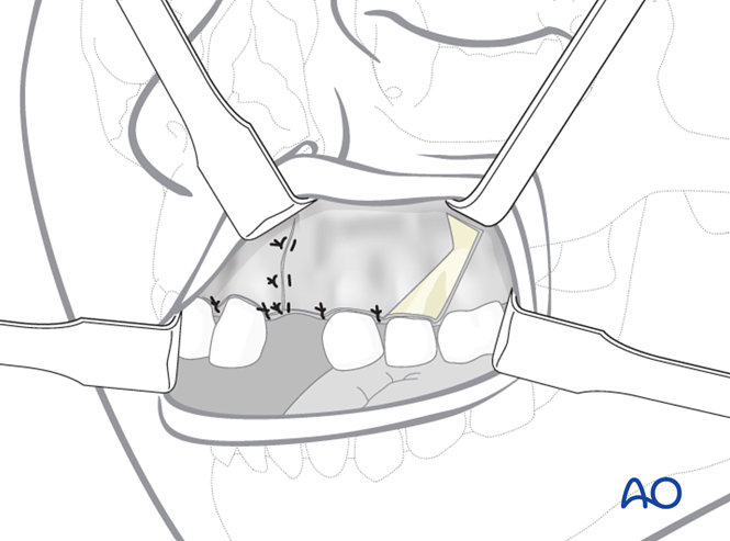 Alveolar bone grafting for Unilateral cleft lip and/or palate