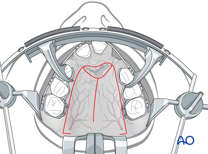 Alveolar bone grafting for Bilateral cleft lip and/or palate
