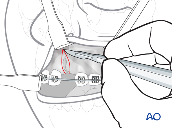 Alveolar bone grafting for Bilateral cleft lip and/or palate