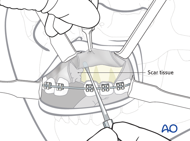 Alveolar bone grafting for Bilateral cleft lip and/or palate