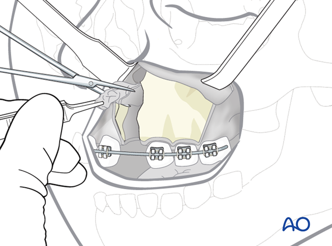 Alveolar bone grafting for Bilateral cleft lip and/or palate with ...