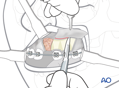 Alveolar bone grafting for Bilateral cleft lip and/or palate