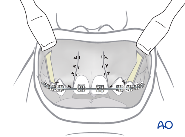 Alveolar bone grafting for Bilateral cleft lip and/or palate