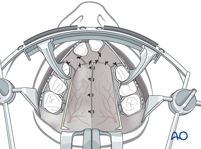 Alveolar bone grafting for Bilateral cleft lip and/or palate