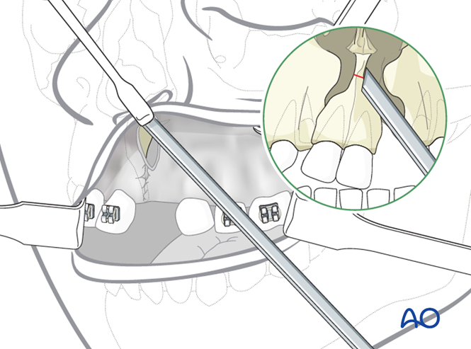 Alveolar bone grafting for Bilateral cleft lip and/or palate with ...
