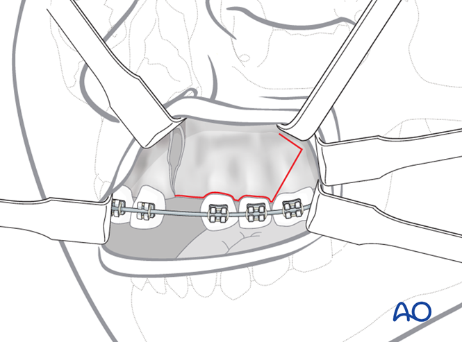 Alveolar bone grafting for Bilateral cleft lip and/or palate with ...