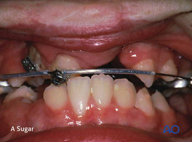 Alveolar bone grafting for Bilateral cleft lip and/or palate with ...