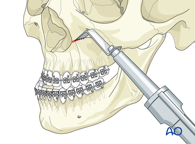 Le Fort I osteotomy - Conventional for Bilateral cleft lip and/or palate