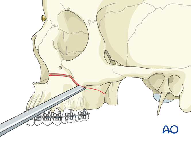 Le Fort I osteotomy - Conventional for Bilateral cleft lip and/or palate