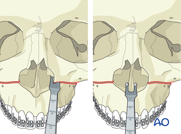 Le Fort I osteotomy - Conventional for Unilateral cleft lip and/or palate