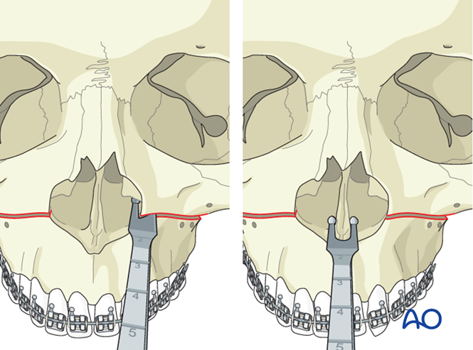 Le Fort I osteotomy - Conventional for Bilateral cleft lip and/or palate