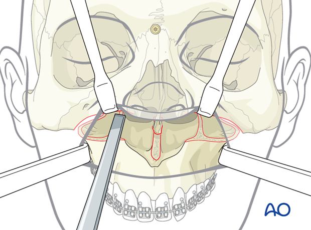 Le Fort I osteotomy - Conventional for Unilateral cleft lip and/or palate