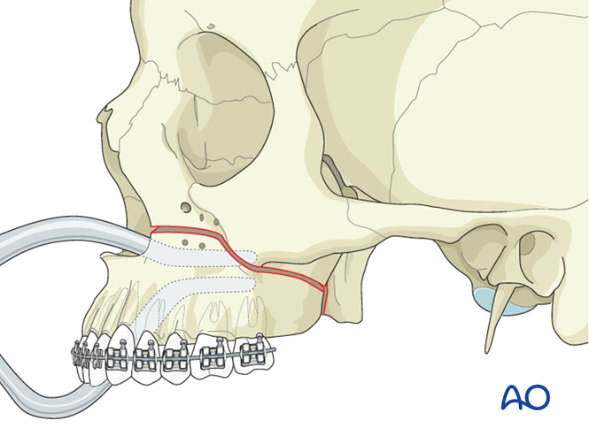 Le Fort I osteotomy - Conventional for Bilateral cleft lip and/or palate