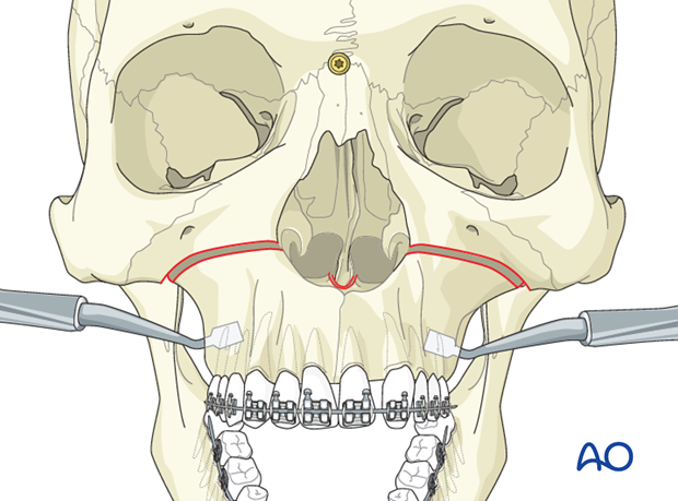 Le Fort I osteotomy - Conventional for Unilateral cleft lip and/or palate