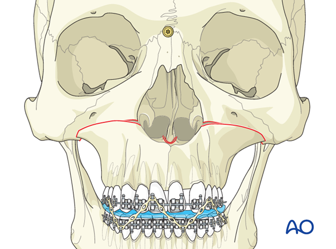 Le Fort I osteotomy - Conventional for Unilateral cleft lip and/or palate