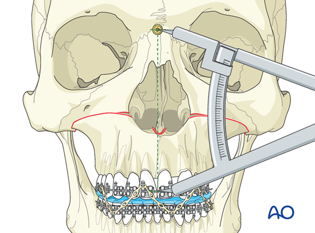 Le Fort I osteotomy - Conventional for Unilateral cleft lip and/or palate