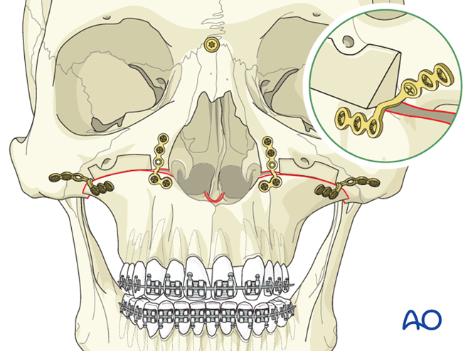 Le Fort I osteotomy - Conventional for Unilateral cleft lip and/or palate